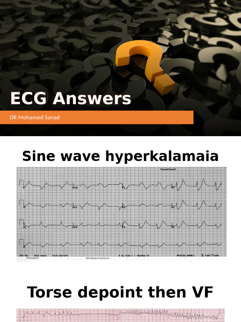 ECG Interpretations and Conditions | PDF
