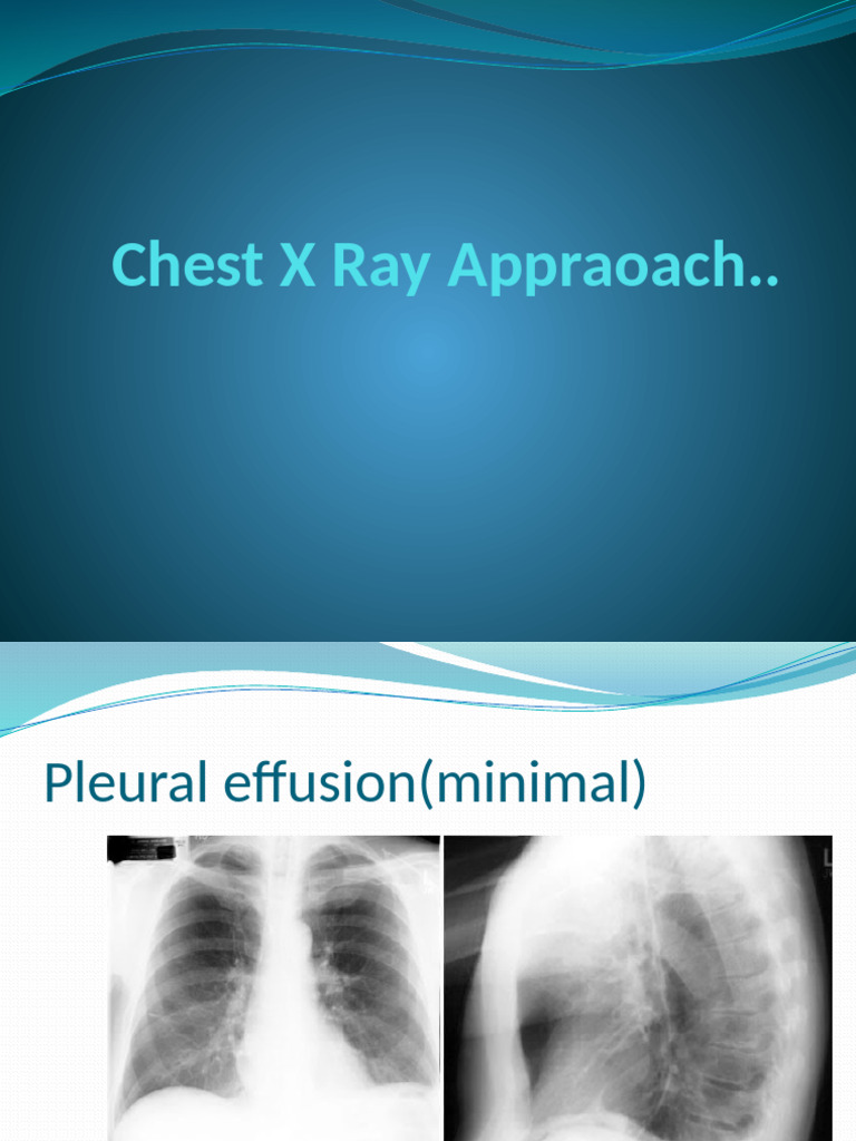 Chest X-Ray Interpretation Guide | PDF