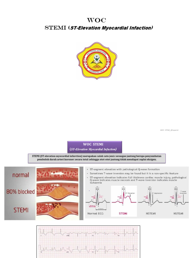 WOC STEMI - Suparmi 1 | PDF