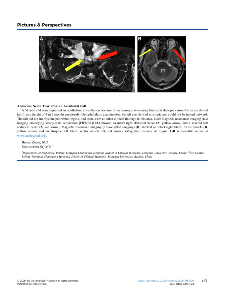 Abducens Nerve Tear After An Accidental Fall 2024 | PDF
