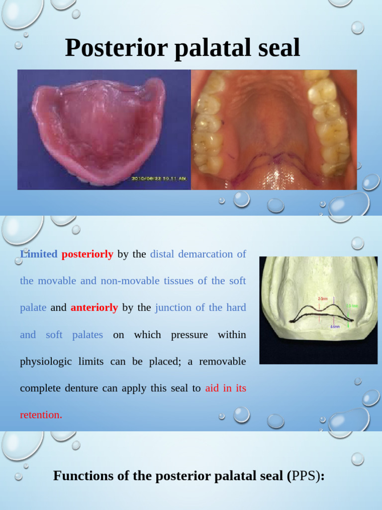 Posterior Palatal Seal Techniques | PDF | Dentures