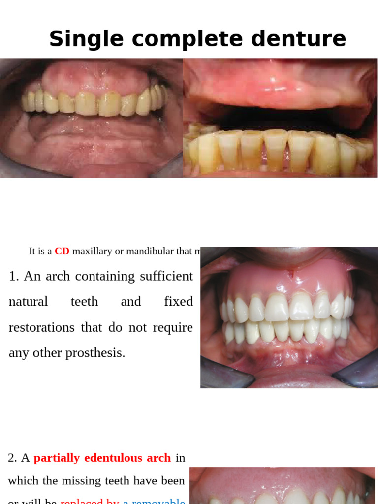 Single complete denture | PDF | Dentures | Medical Specialties