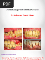 Understanding Linear Gingival Erythema | PDF | Periodontology | Medicine