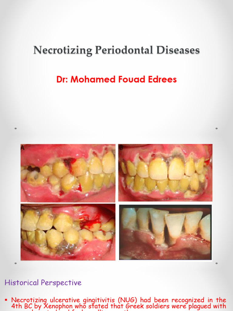 NECROTIZING ULCERATIVE GINGIVITIS | PDF | Periodontology | Medical Specialties