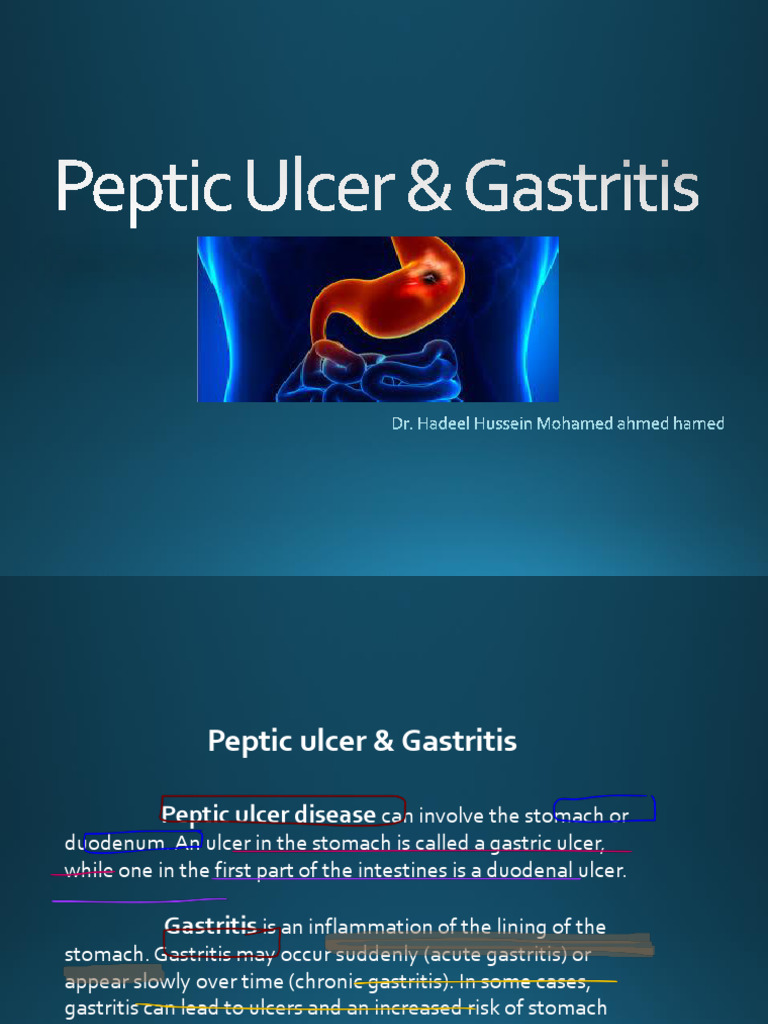 2- Peptic Ulcer & Gastritis | PDF | Clinical Medicine | Digestive Diseases