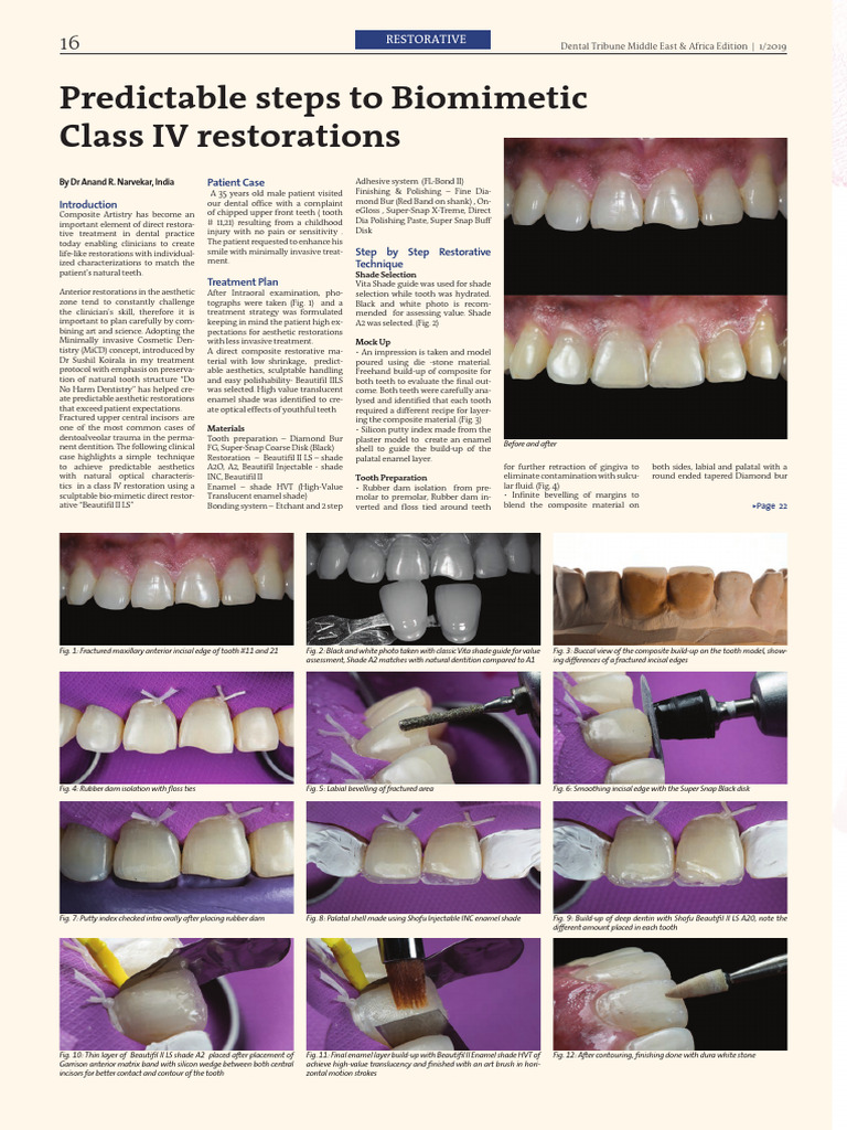 Beautifil II LS Article Predictable Steps To Biomimetic Class IV ...