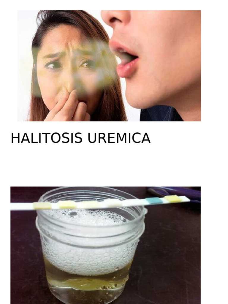 Halitosis Uremica 2 | PDF