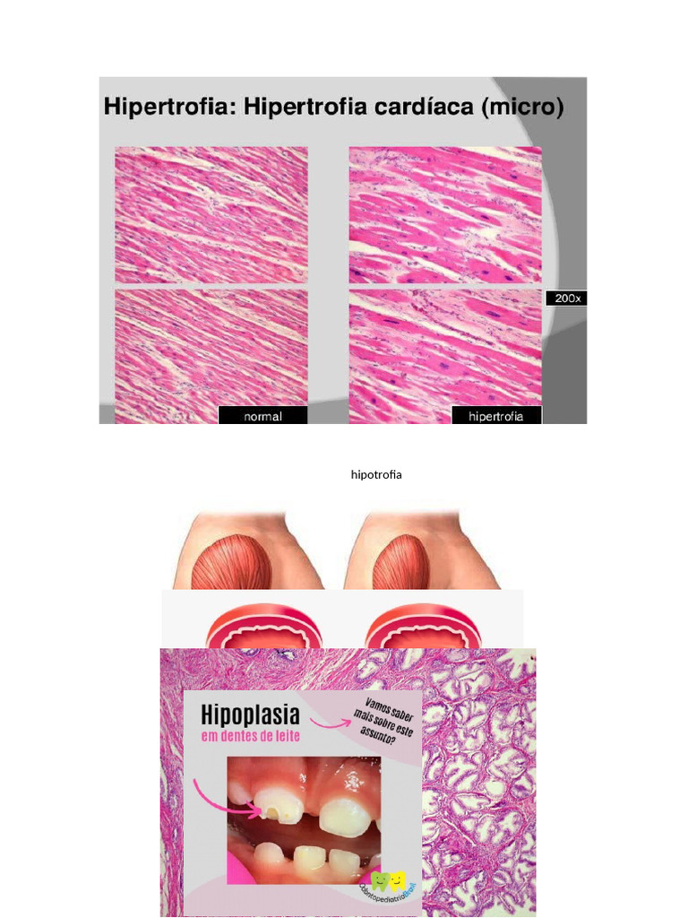 Hipotrofia | PDF