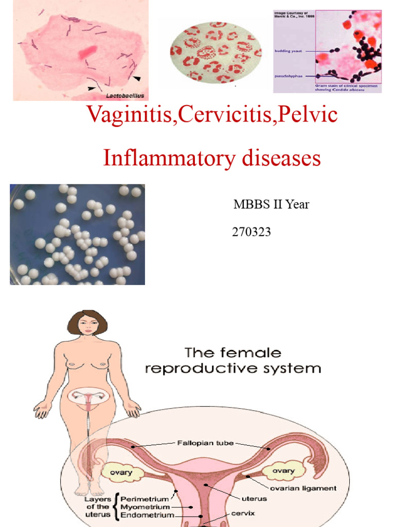 Vaginitis,Cervicitis,PID 2023(1) | PDF | Candidiasis | Medical Specialties