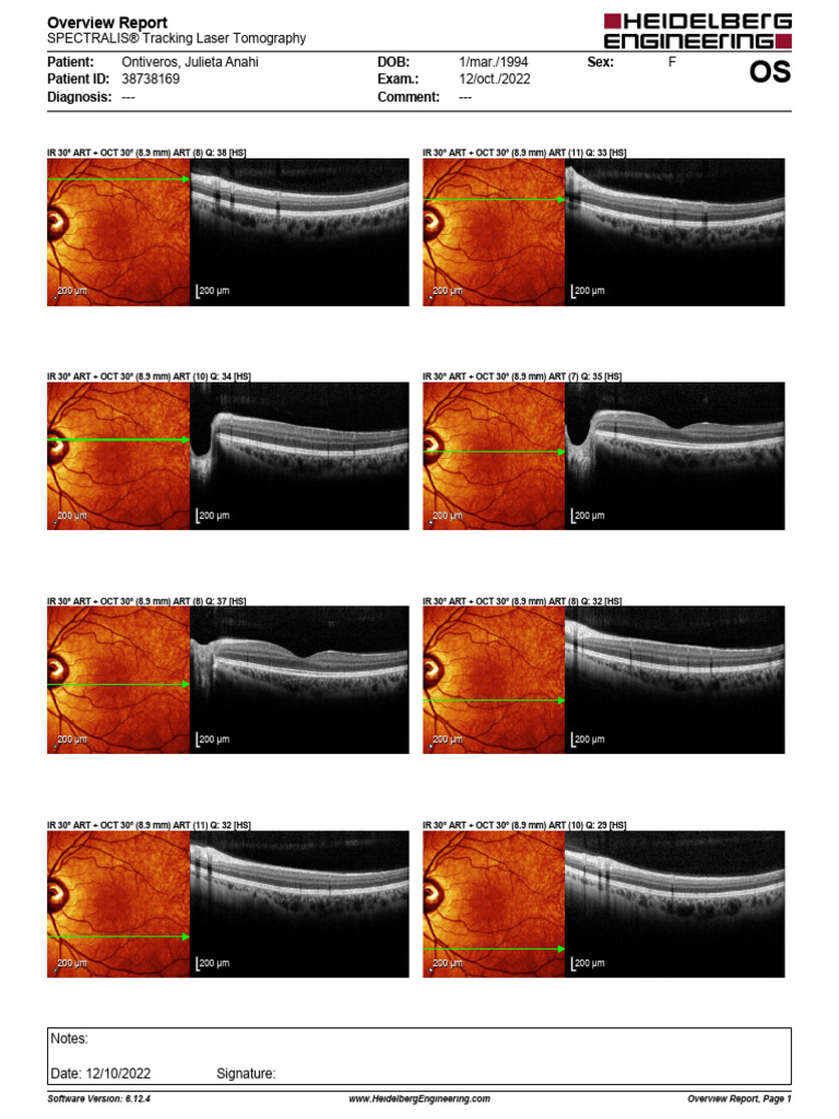 SPECTRALIS Laser Tomography Report | PDF