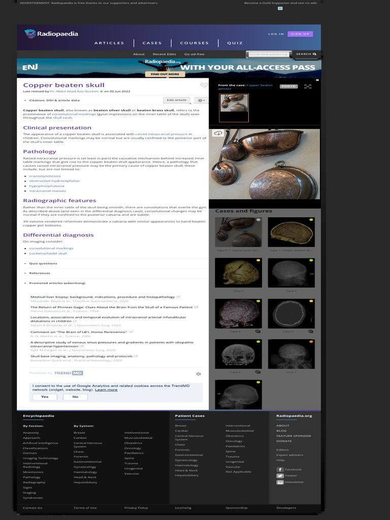 Copper Beaten Skull Radiology Reference Article | PDF