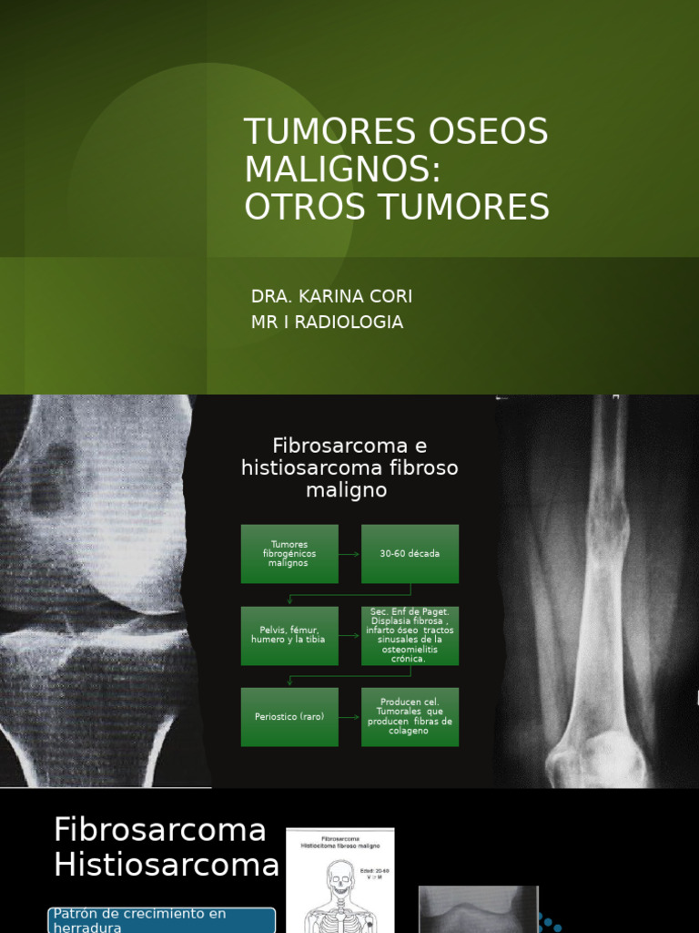 Tumores Oseos Malignos | PDF | Hueso | Sistema esquelético