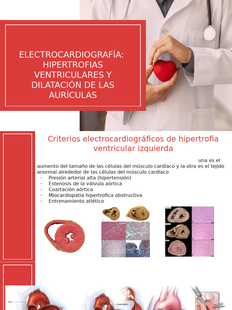 Criterios ECG de Hipertrofia y Dilatación Cardíaca | PDF | Sistema ...