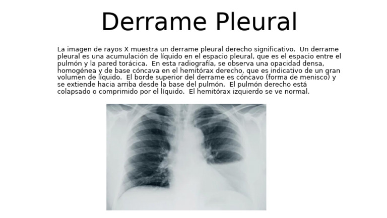 Derrame pleural en radiografía lateral | PDF