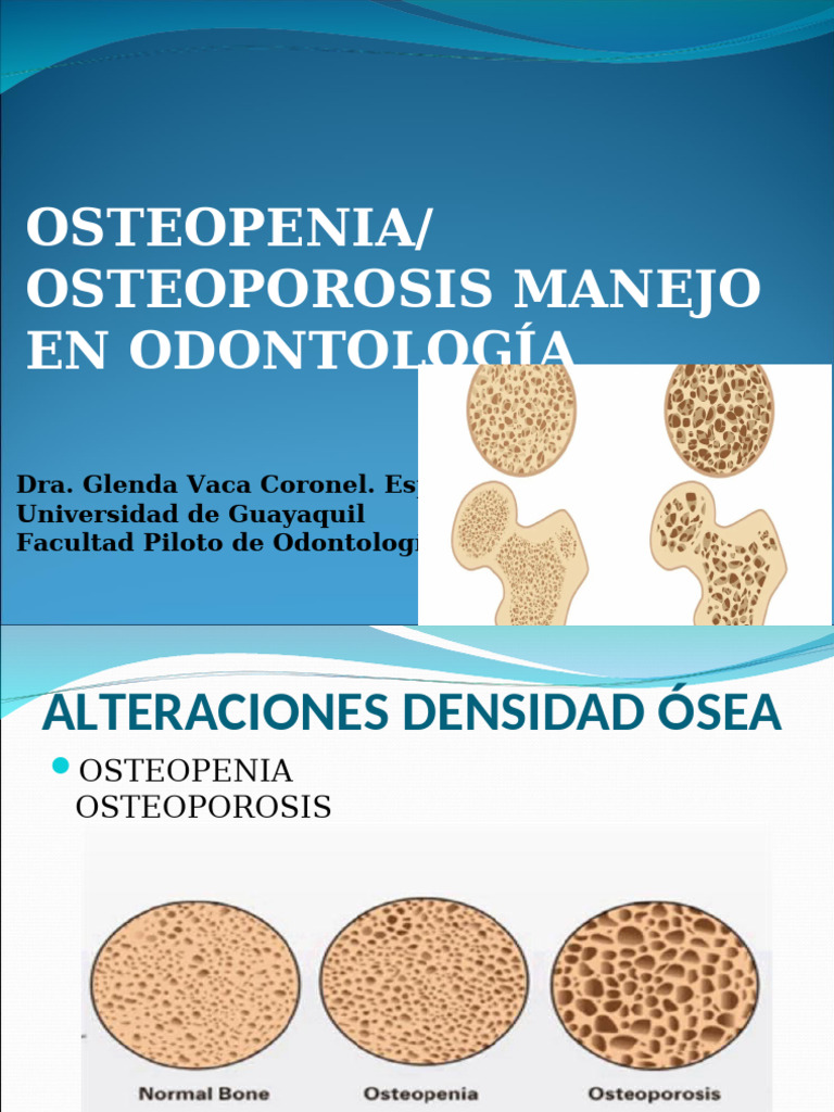 Osteopenia Osteoporosis | PDF | Osteoporosis | Hueso