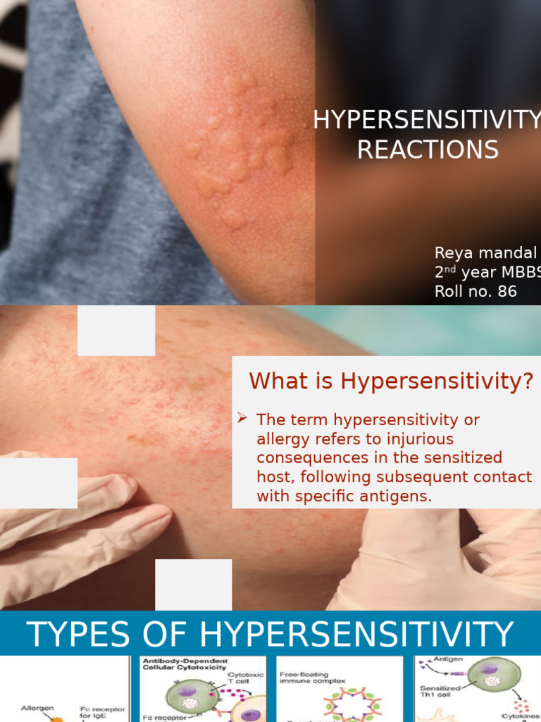 Hypersensitivity | PDF | Complement System | Antibody