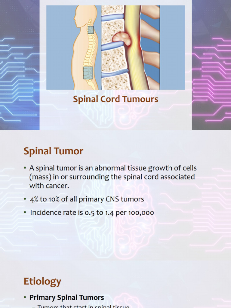 Spinal Cord Tumours | PDF