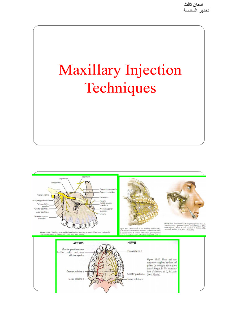 السادسة-Maxillary Injection Techniques | PDF | Human Nose | Anesthesia