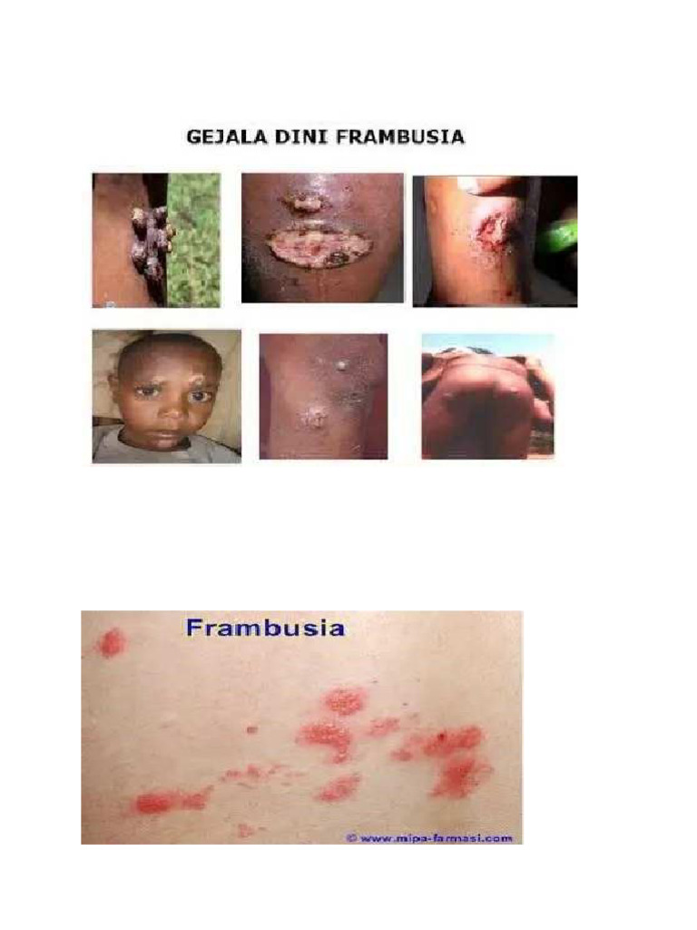 Panduan Pencegahan Frambusia | PDF
