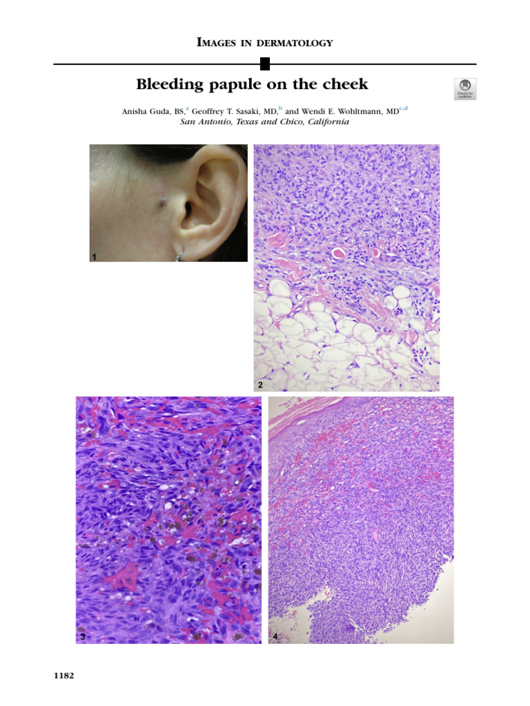 Bleeding Papule On The Cheek - 2020 - JDCR | PDF | Skin Cancer | Melanoma