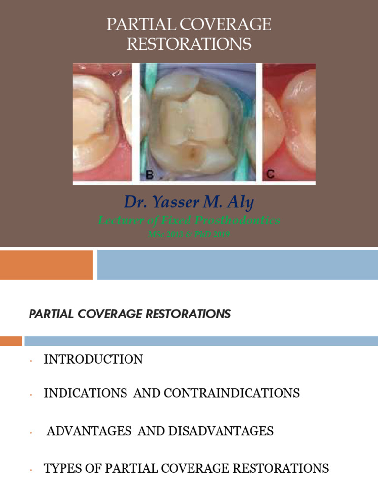 Overview of Partial Coverage Restorations | PDF | Dentistry Branches ...