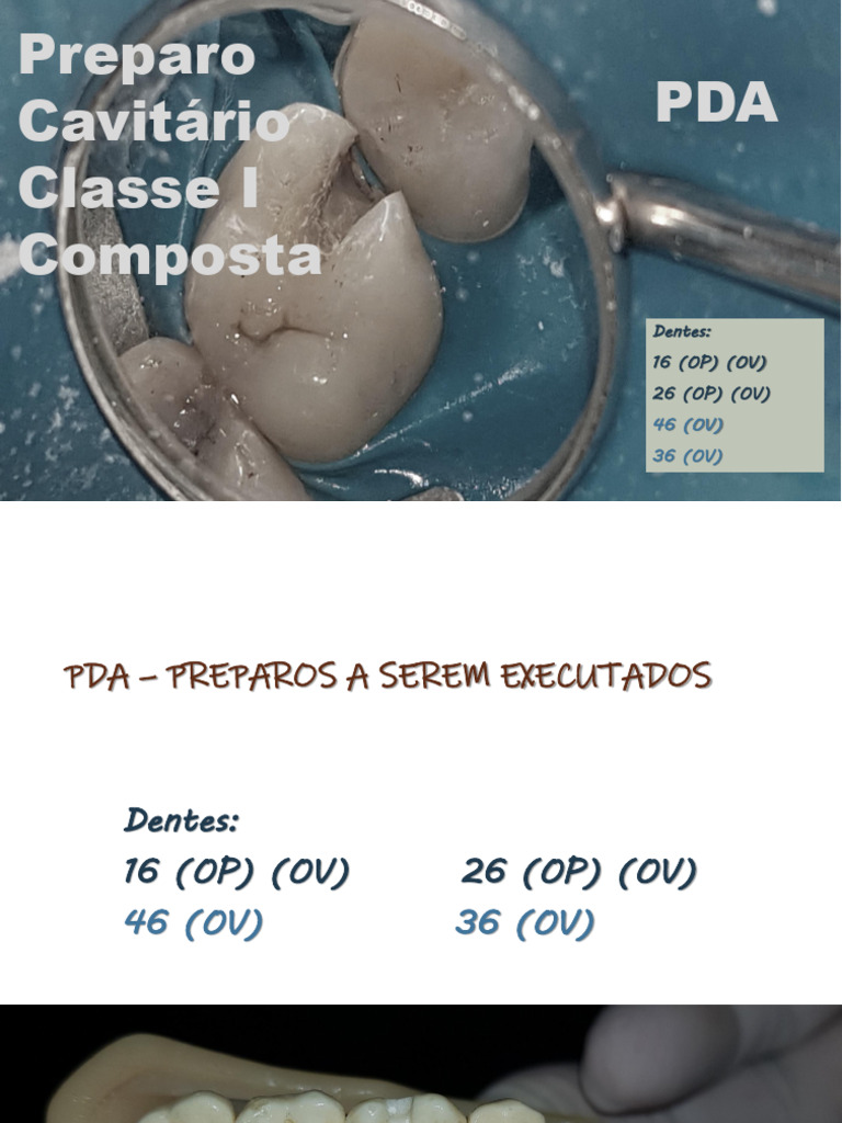 Aula Prática 5 - Preparo Classe I Composta | PDF | Dente | Áreas da ...