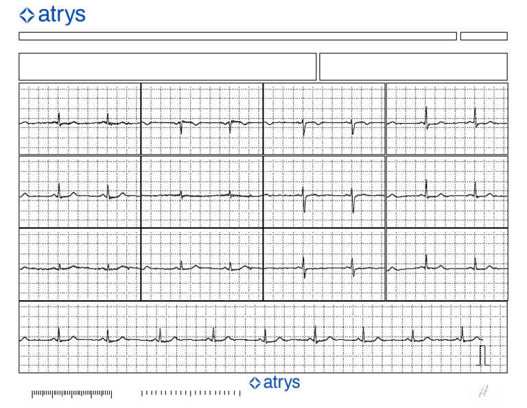 Ecg Sofia Sandoval Diaz | PDF