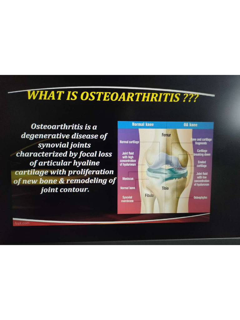 Osteoarthritis Pdf