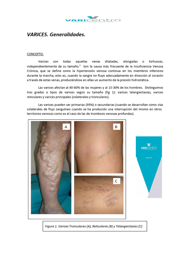 Varices Generalidades | PDF | Venas varicosas | El embarazo