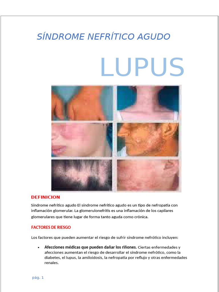 Lupus | PDF | Sistema inmune | Virus