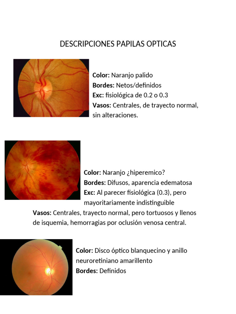 Descripción de Papilas Ópticas Hiperémicas | PDF