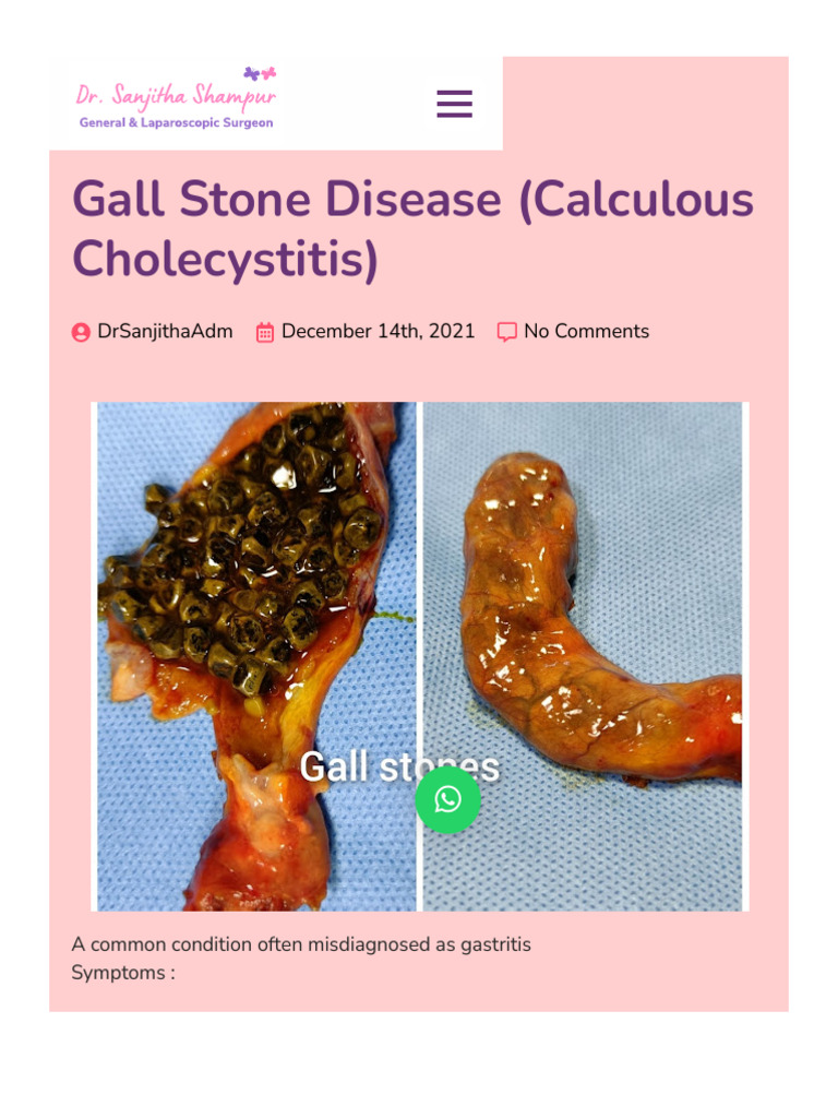 Gall Stone Disease (Calculous Cholecystitis) - DR Sanjitha Shampur ...