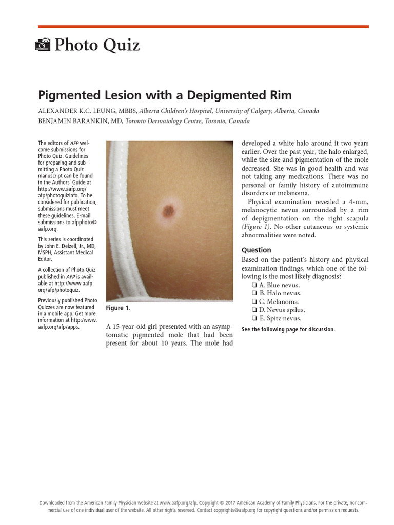 Pigmented Lesion With A Depigmented Rim | PDF | Skin | Dermatology