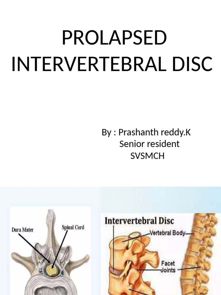 Prolapsed Intervertebral Disc | PDF