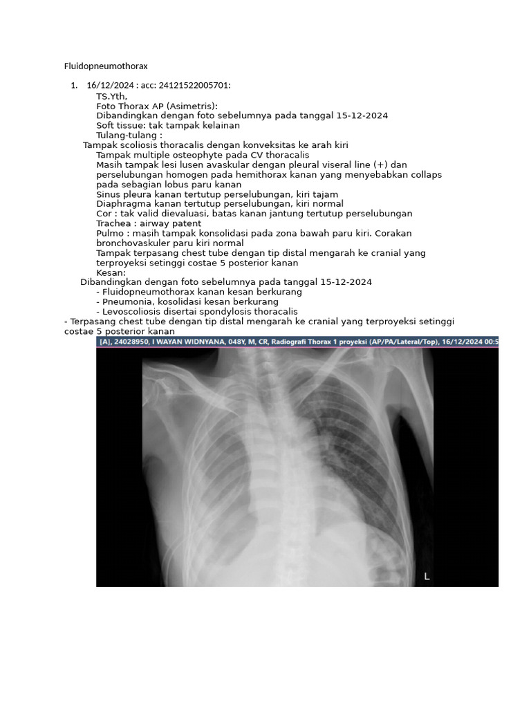 Evaluasi Fluidopneumothorax dan Pneumonia | PDF
