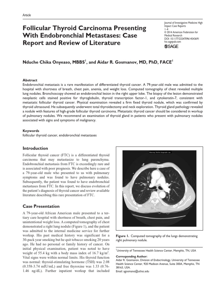 Follicular Thyroid Carcinoma Presenting With Endobronchial Metastases: Case Report and Review of ...