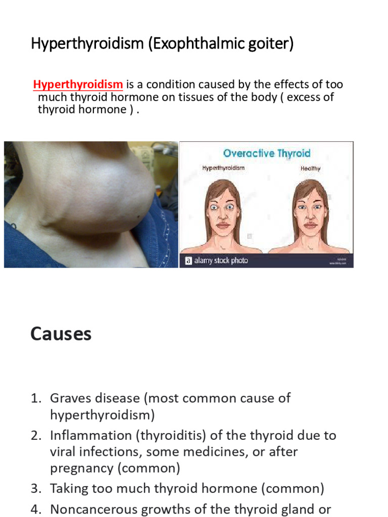 Hyperthyrodisim Student | PDF | Hyperthyroidism | Thyroid