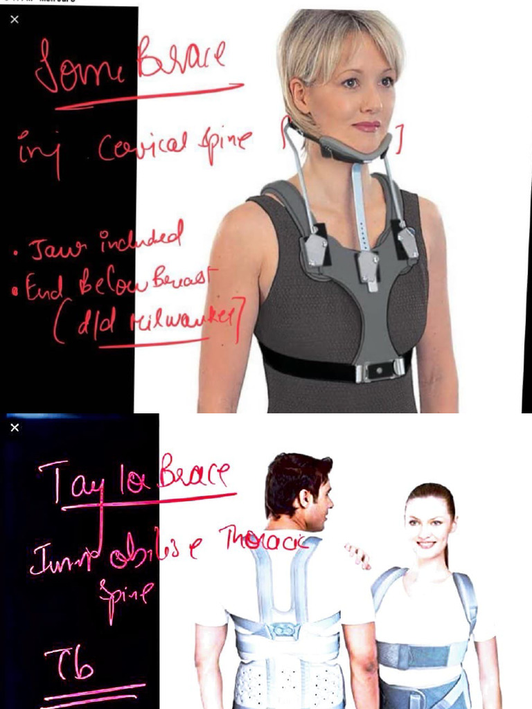 Important Splints and Casts | PDF