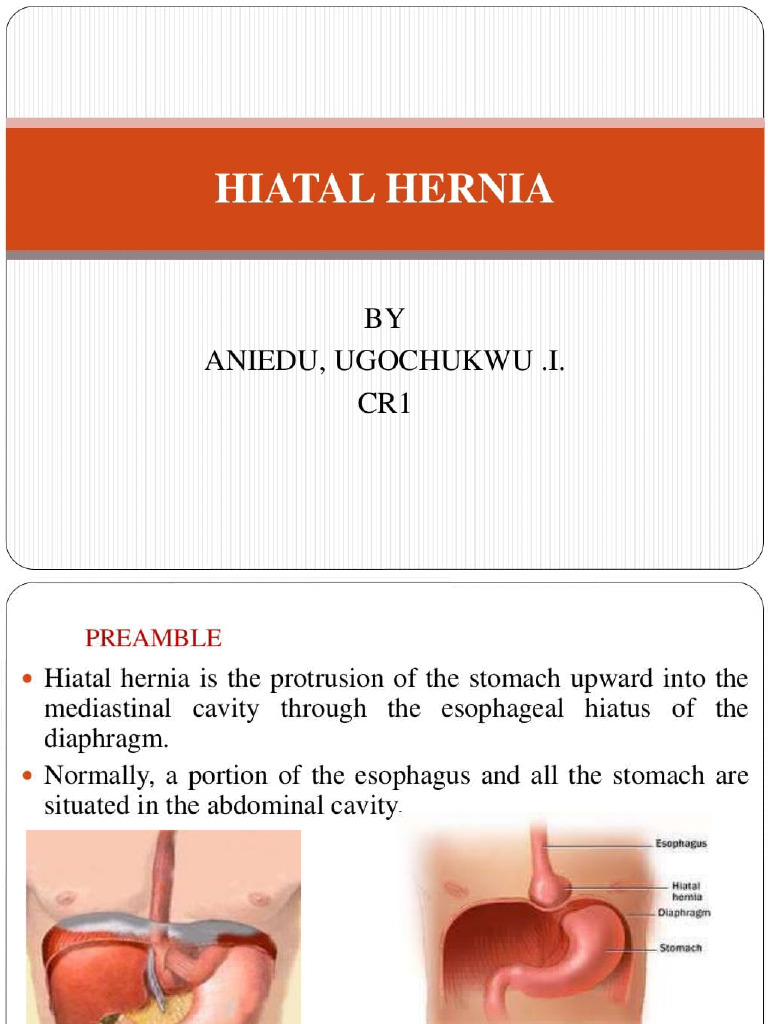 1 Hiatal Hernia | PDF