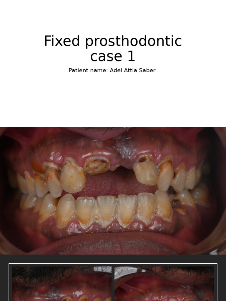 Fixed Prostho Case 1 | PDF