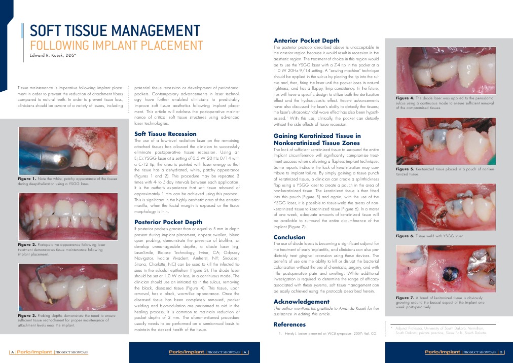Soft Tissue Management | PDF | Dental Implant | Laser
