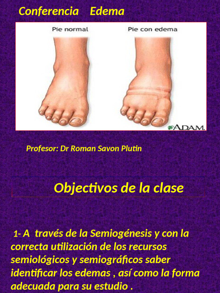 Aula de Edema. Propedêutica | PDF | Edema | Medicina CLINICA