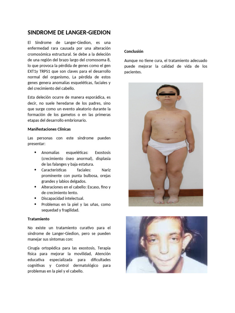 Sindrome de Langer Giedion | PDF