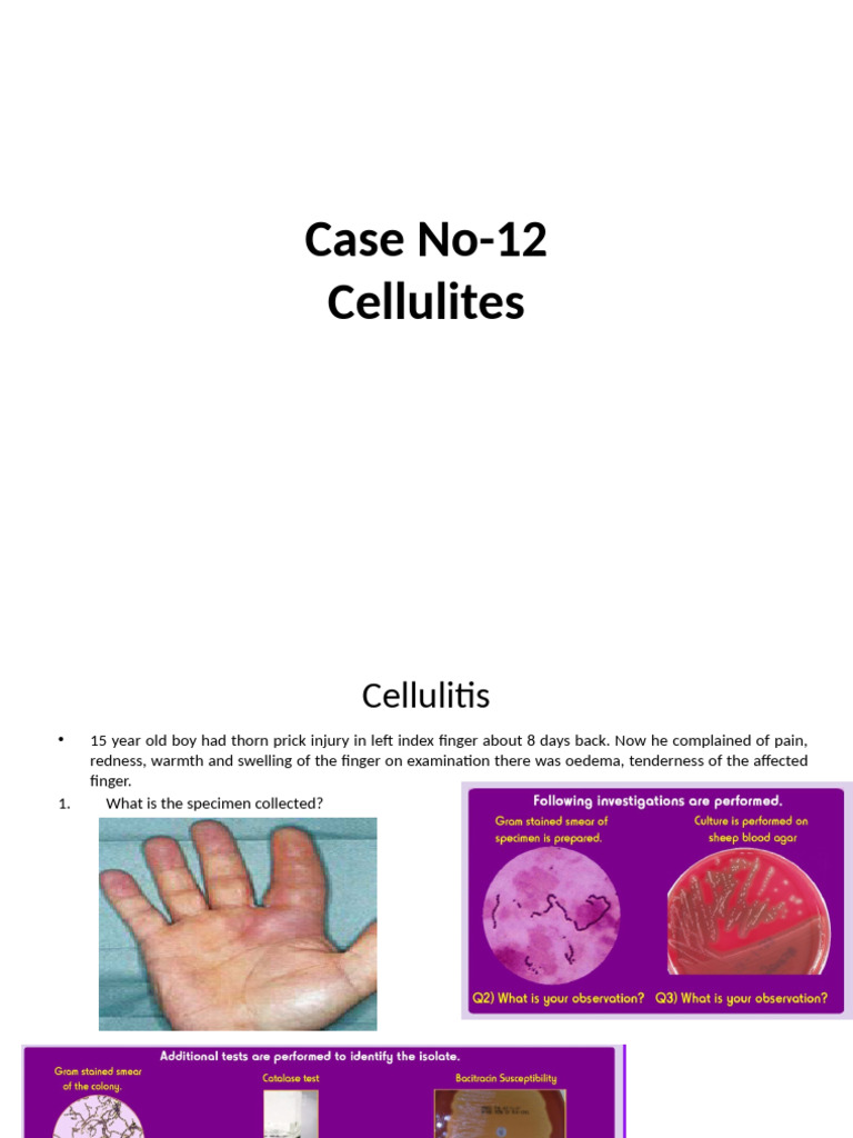 Cellulitis Case 12,13 &14 | PDF | Methicillin Resistant Staphylococcus Aureus | Staphylococcus ...