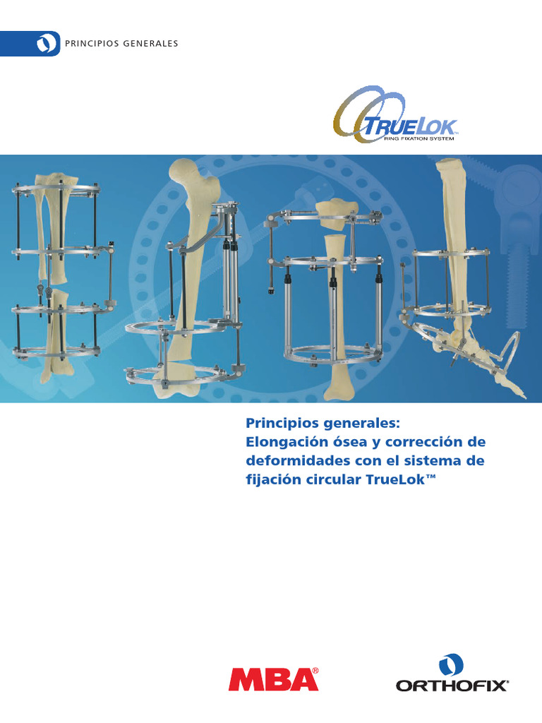 ORTHOFIX TrueLok Principios Basicos TL 1001 OPT S0 BAJA | PDF ...