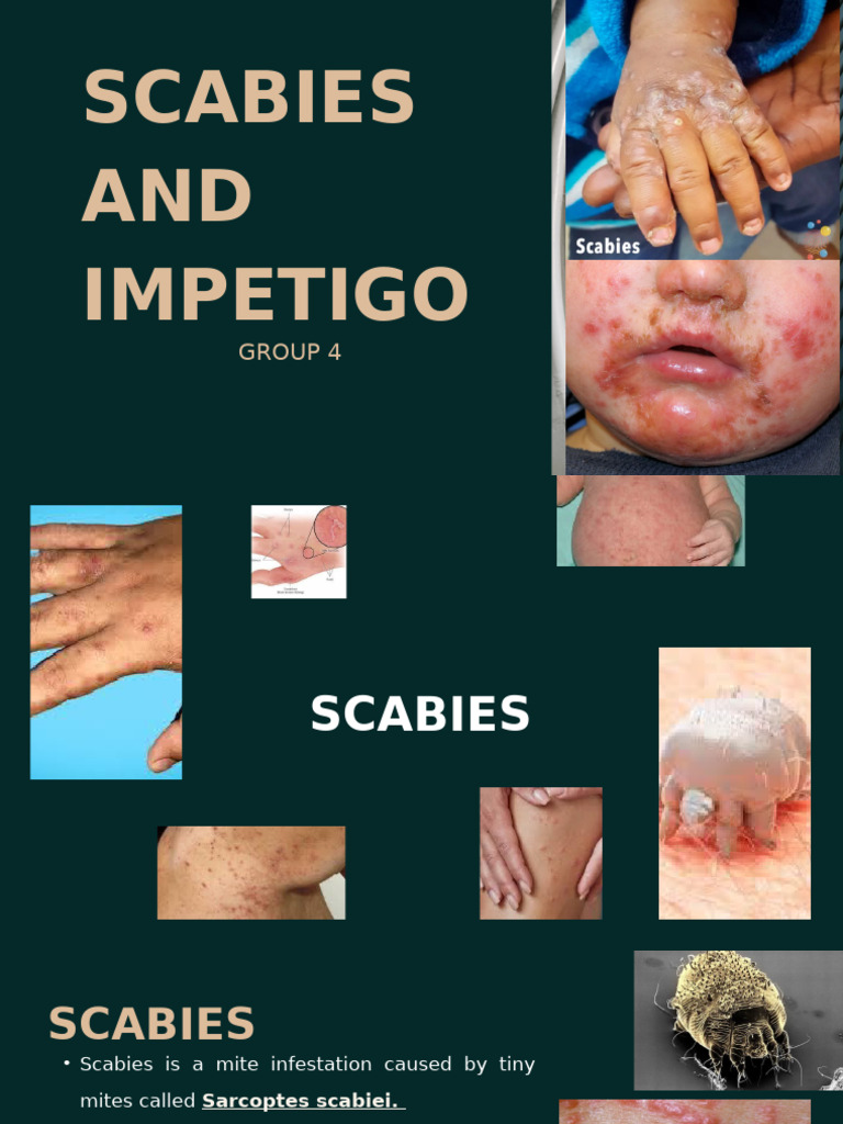 Group 14 Scabies Impetigo | PDF | Human Diseases And Disorders ...