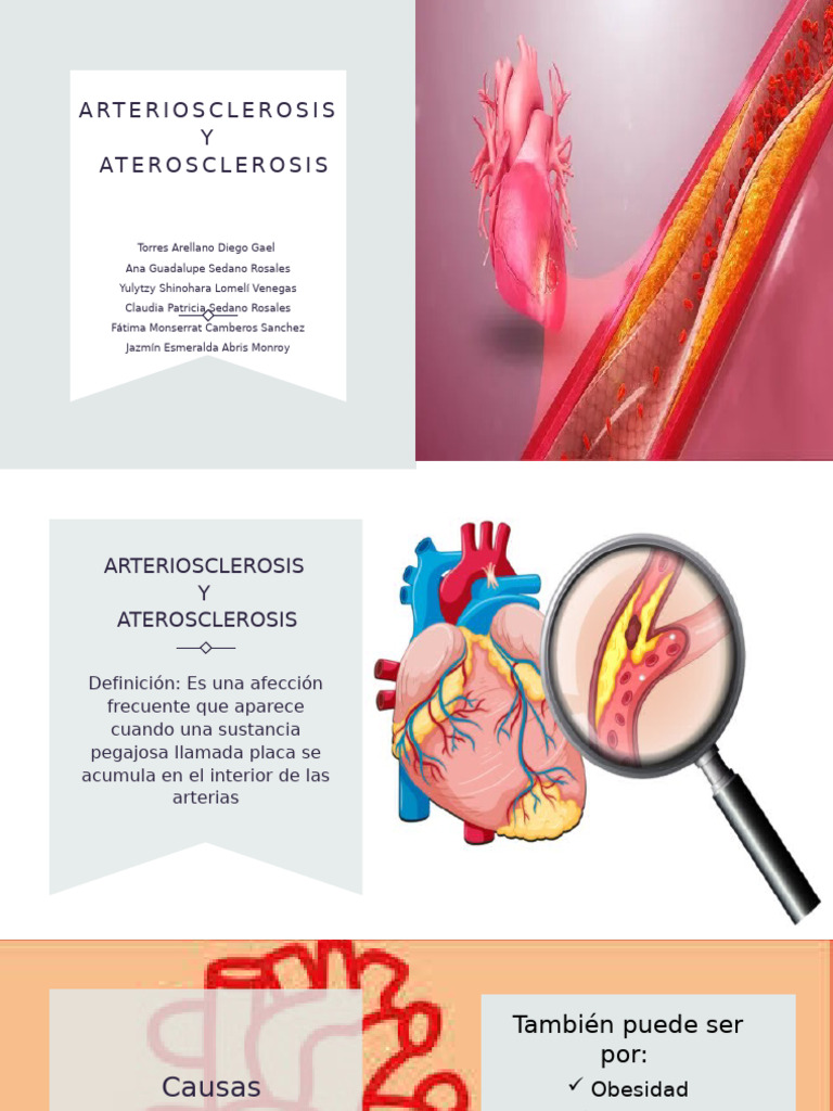 ARTERIOSCLEROSIS Y ATEROSCLEROSIS | PDF | Aterosclerosis | Carrera