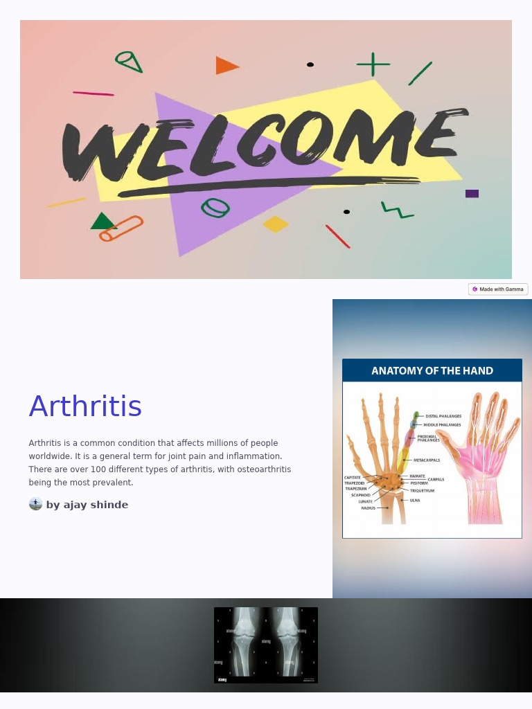 Arthritis by Ajay Shinde | PDF | Osteoarthritis | Joint