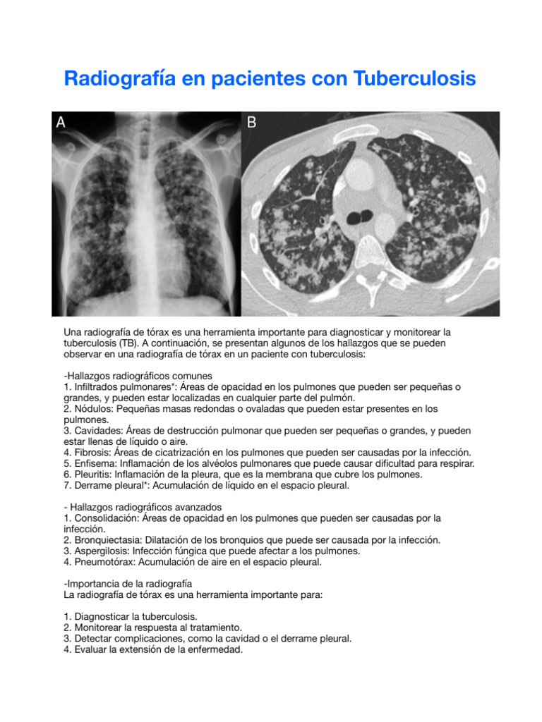 RX Tuberculosis | PDF