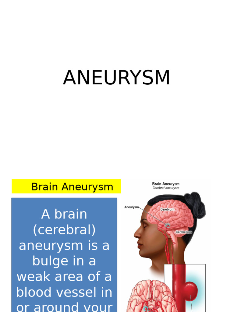 3-2-2025-NCM-116-Lesson-6-ANEURYSM 2 | PDF | Angiography | Headache